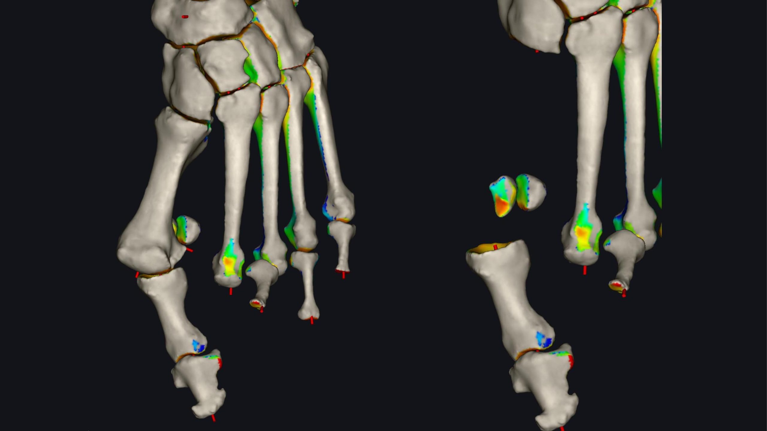 Chirurgia Mininvasiva Alluce Valgo: Tecnica ed Evoluzione